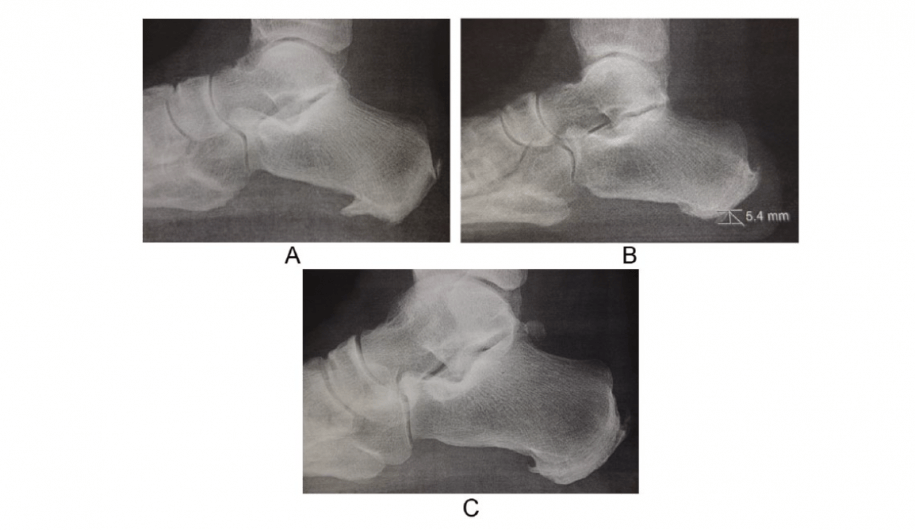 Hielspoor behandeling - Fysiotherapie en cupping therapie